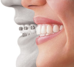 Ortodoncia Invisalign vs Frenillos metálicos